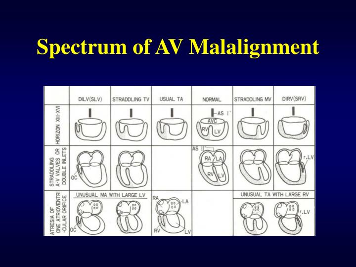 PPT - Double Inlet Ventricle PowerPoint Presentation - ID:282508
