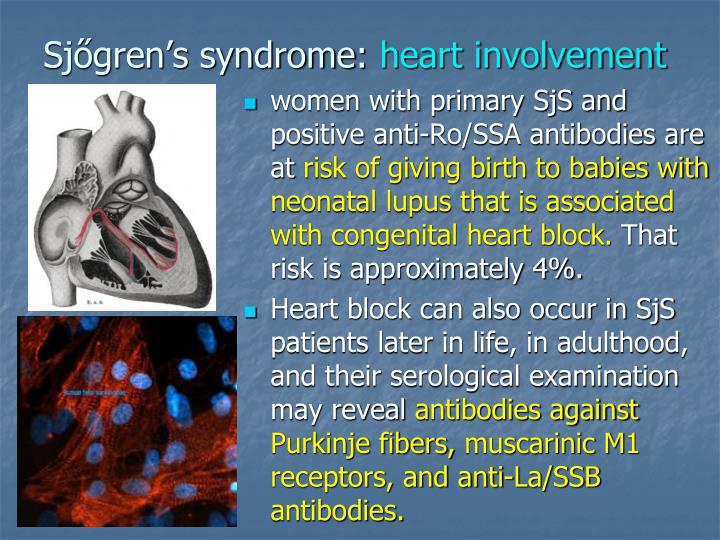 PPT - The Kidney in Autoimmune Diseases Renal involvement in primary ...