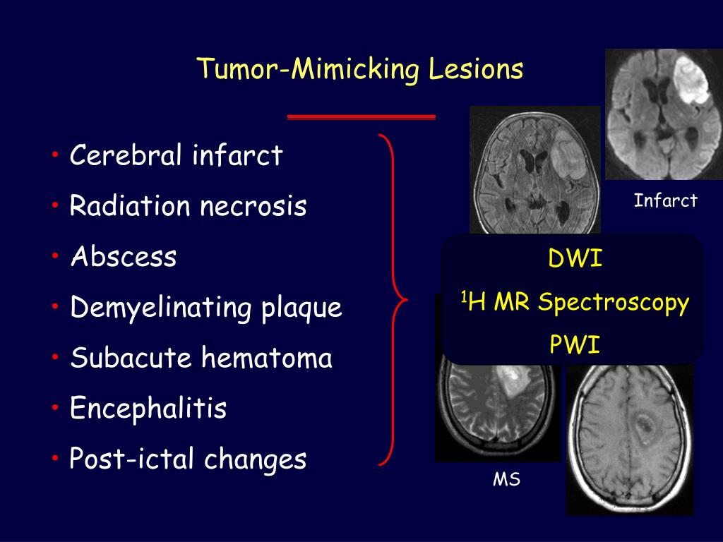 Ppt Adult Brain Tumors Powerpoint Presentation Free Download Id287986