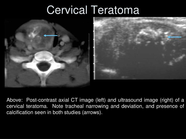 PPT - Teratomas of the Brain and Head and Neck PowerPoint Presentation ...