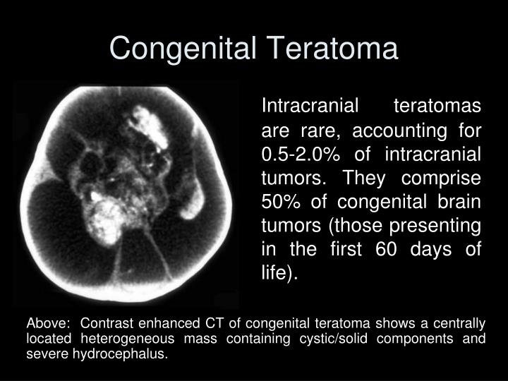PPT - Teratomas of the Brain and Head and Neck PowerPoint Presentation ...