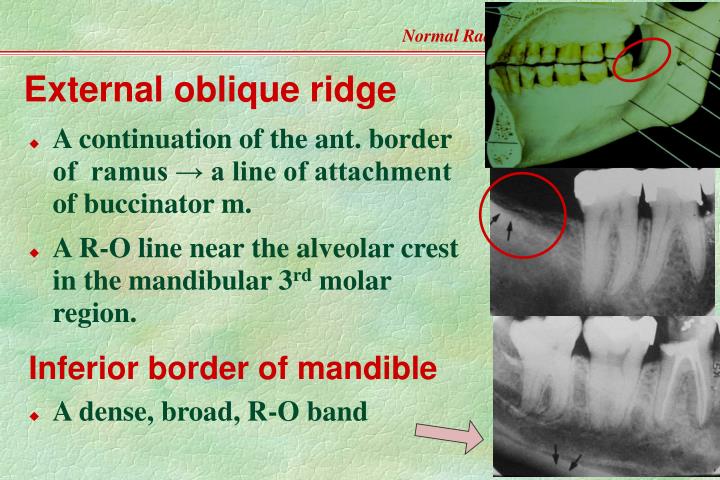 PPT - Normal Radiographic Anatomy- Based on Intraoral Films PowerPoint ...