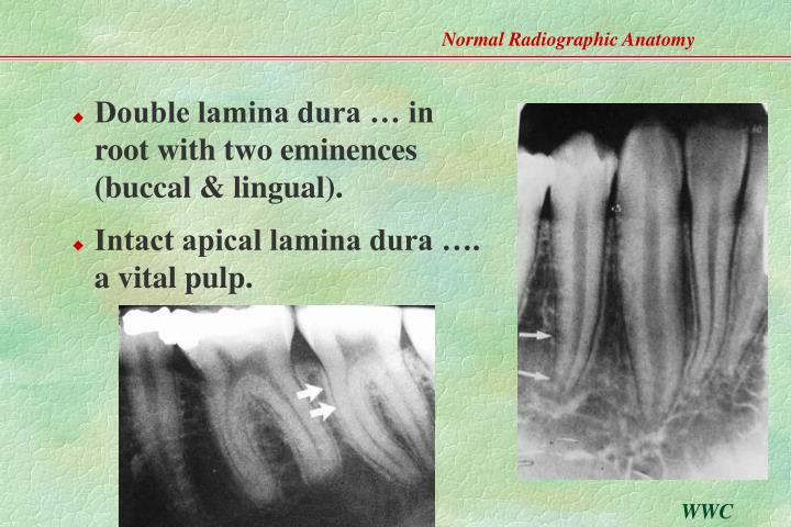 PPT - Normal Radiographic Anatomy- Based on Intraoral Films PowerPoint ...