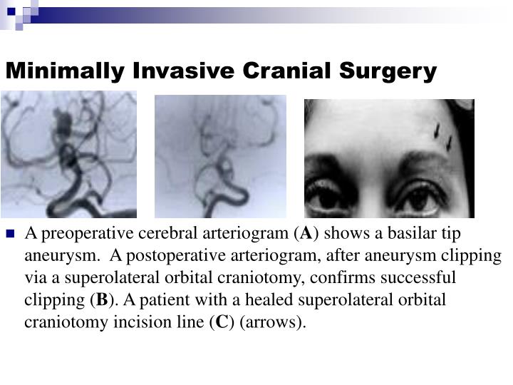 PPT - Care of the Client with Cranial Surgery PowerPoint Presentation ...