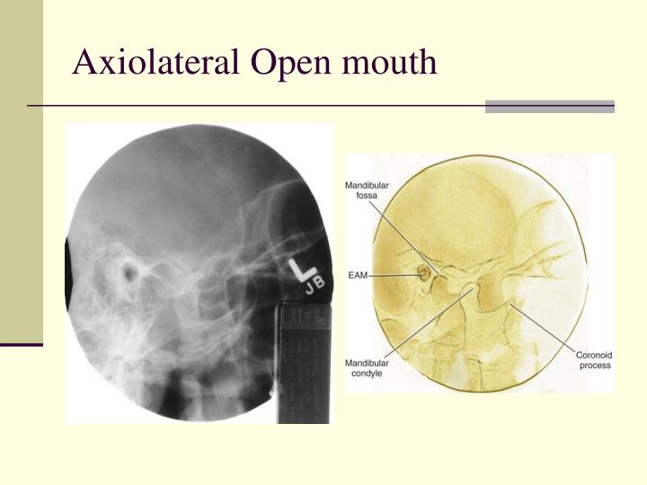 PPT - Mandible & TMJ Lecture PowerPoint Presentation - ID:292789