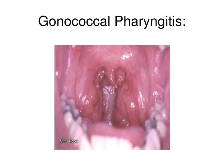 PPT - Otitis & Pharyngitis in Peds Chp 121 Tintinalli PowerPoint ...