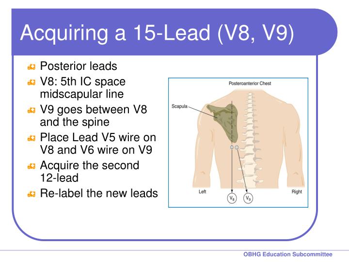 PPT - Chapter 8 for 12 Lead Training -The 15 Lead ECG- PowerPoint ...