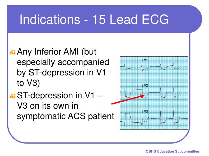 PPT - Chapter 8 for 12 Lead Training -The 15 Lead ECG- PowerPoint ...