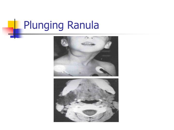 PPT - Embryology of the Neck & Neck Masses PowerPoint Presentation - ID ...