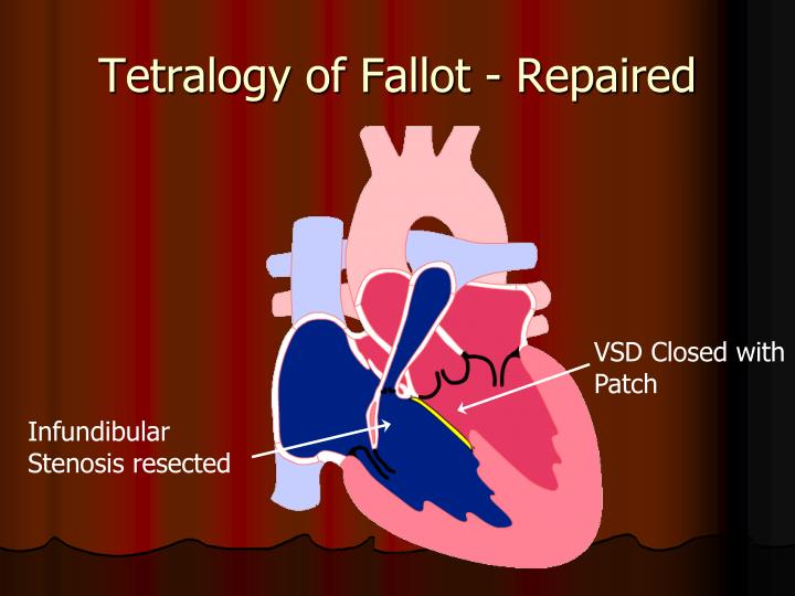 PPT - Surgical perspectives on Congenital Heart Disease Critical Care ...