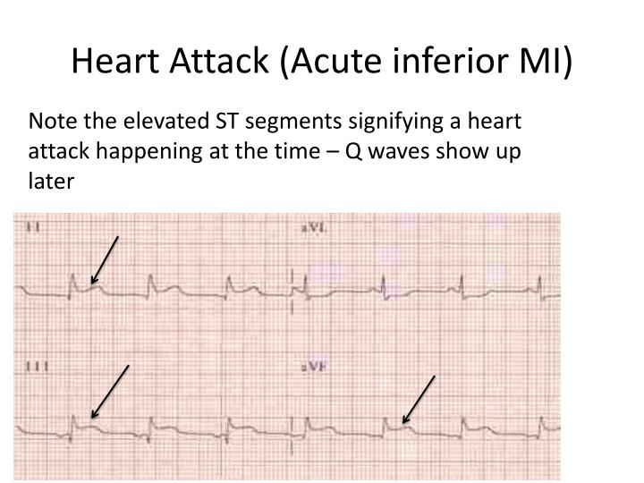 PPT - EKG PowerPoint Presentation - ID:296817