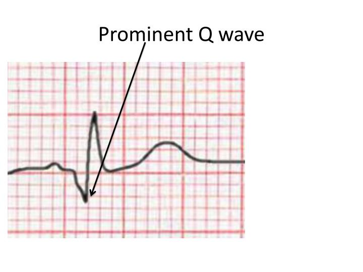 PPT - EKG PowerPoint Presentation - ID:296817