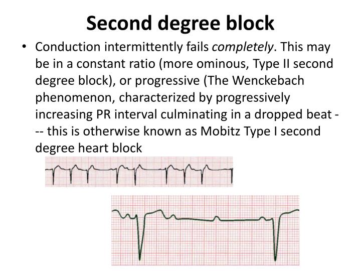 PPT - EKG PowerPoint Presentation - ID:296817