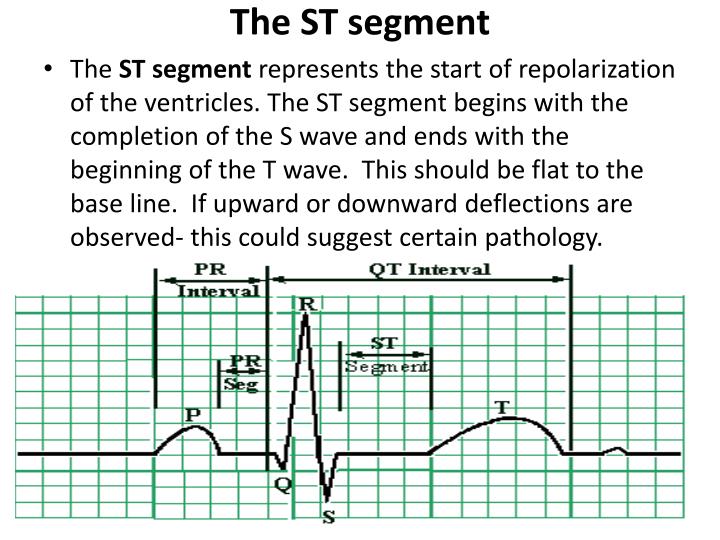 PPT - EKG PowerPoint Presentation - ID:296817