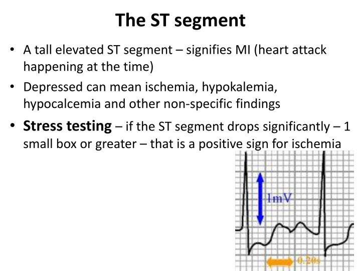 PPT - EKG PowerPoint Presentation - ID:296817