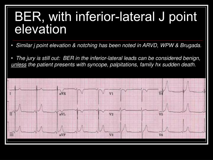 PPT - Top Ten (or 11) EKG Killers PowerPoint Presentation - ID:296841