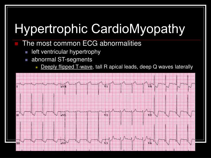 PPT - Top Ten (or 11) EKG Killers PowerPoint Presentation - ID:296841