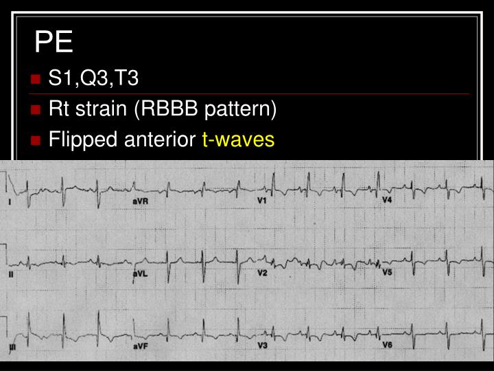 PPT - Top Ten (or 11) EKG Killers PowerPoint Presentation - ID:296841