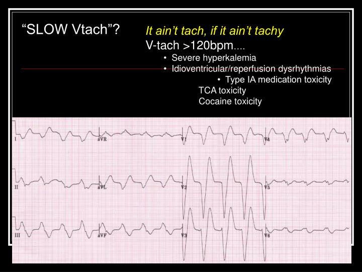 PPT - Top Ten (or 11) EKG Killers PowerPoint Presentation - ID:296841