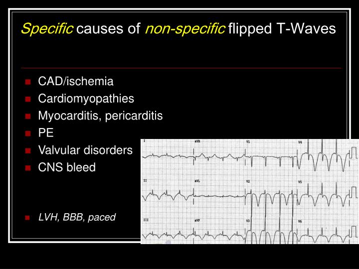 PPT - Top Ten (or 11) EKG Killers PowerPoint Presentation - ID:296841