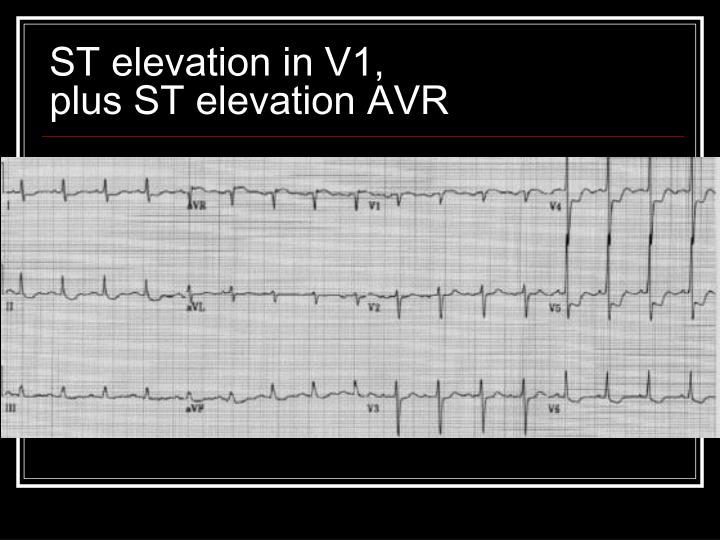 PPT - Top Ten (or 11) EKG Killers PowerPoint Presentation - ID:296841