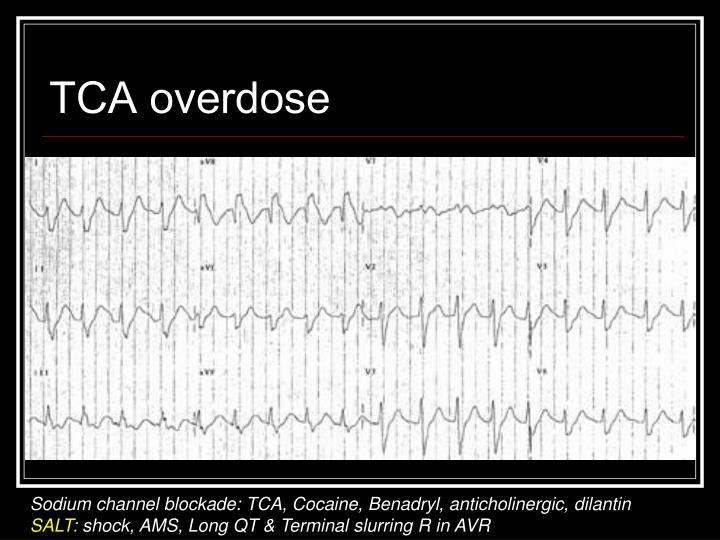 PPT - Top Ten (or 11) EKG Killers PowerPoint Presentation - ID:296841