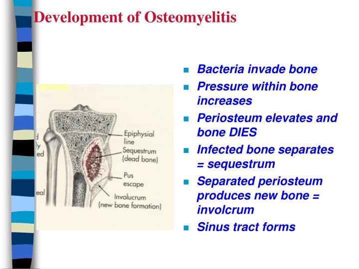PPT - Osteomyelitis PowerPoint Presentation - ID:298370