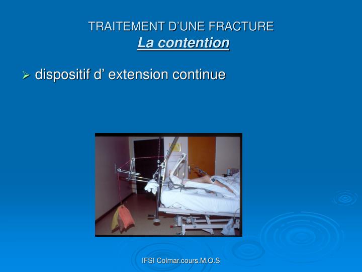 PPT - LES FRACTURES PowerPoint Presentation - ID:299150