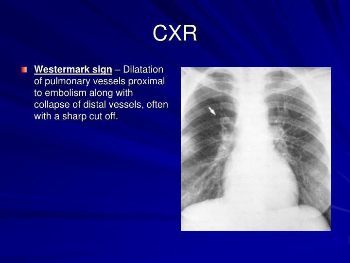 PPT - Radiographic Evaluation of a Pulmonary Embolism PowerPoint ...