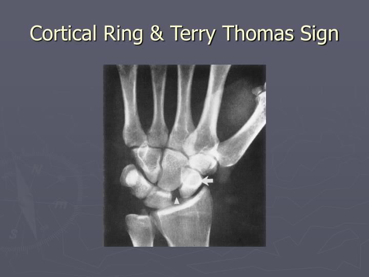 PPT - Wrist Injuries PowerPoint Presentation - ID:300359