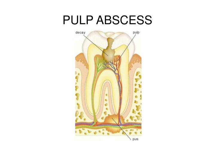 PPT - PERIAPICAL ABSCESS PowerPoint Presentation - ID:300729