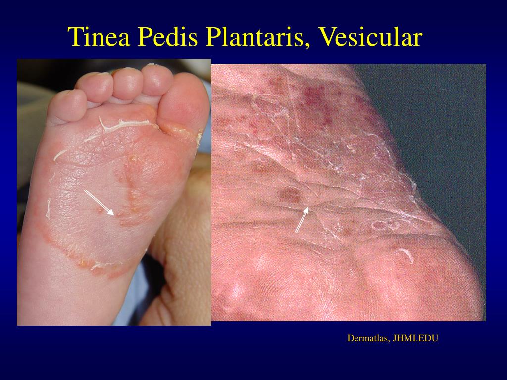 Vesicular Tinea Pedis