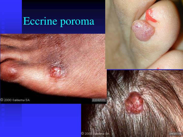 PPT - Andrew’s Diseases of the Skin Epidermal Nevi, Neoplasms, and ...