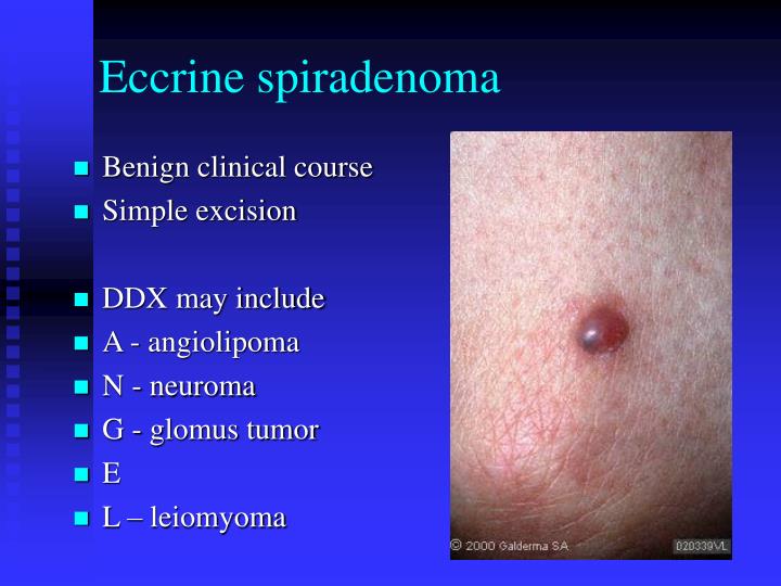 PPT - Andrew’s Diseases of the Skin Epidermal Nevi, Neoplasms, and ...