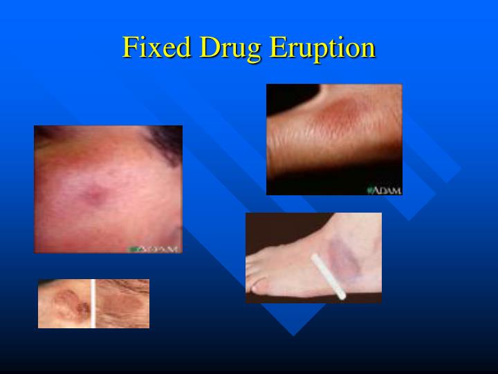 PPT - Part II: Contact Dermatitis & Drug Eruptions PowerPoint ...