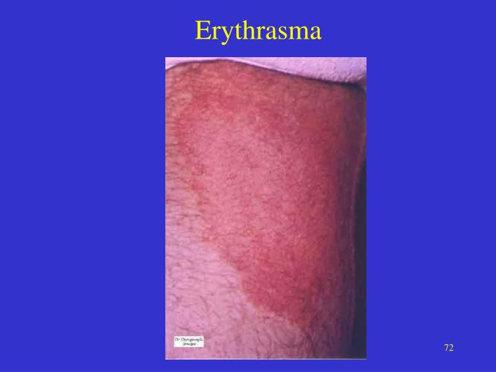 PPT - Bacterial Infections Chapter 14 PowerPoint Presentation - ID:308696