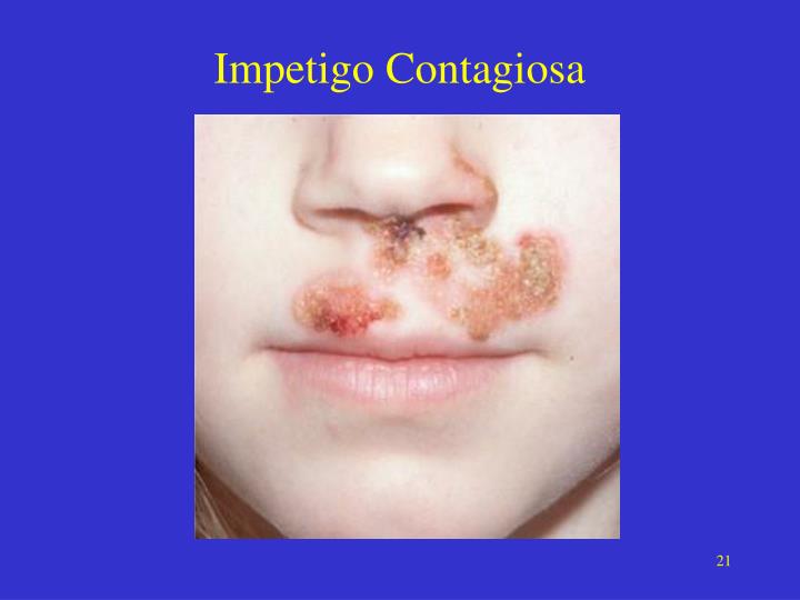 PPT - Bacterial Infections Chapter 14 PowerPoint Presentation - ID:308696