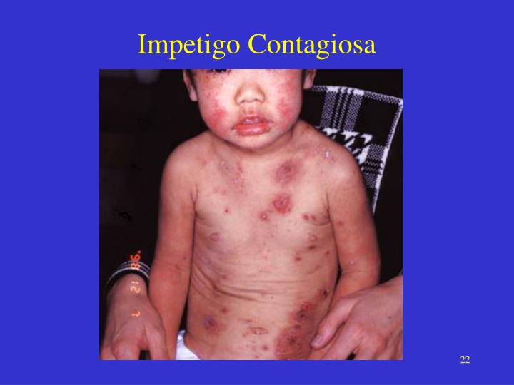 PPT - Bacterial Infections Chapter 14 PowerPoint Presentation - ID:308696