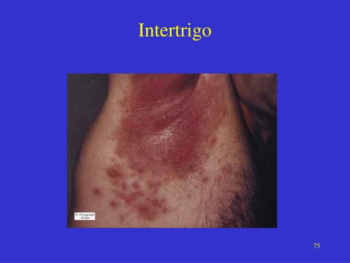 PPT - Bacterial Infections Chapter 14 PowerPoint Presentation - ID:308696