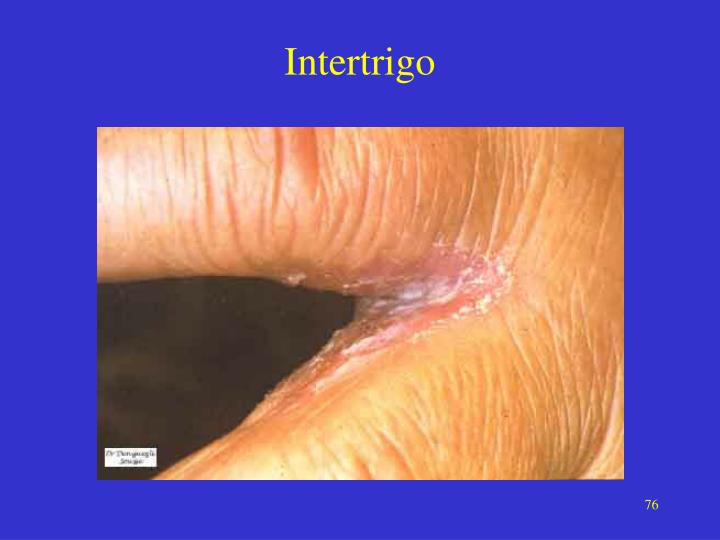 PPT - Bacterial Infections Chapter 14 PowerPoint Presentation - ID:308696