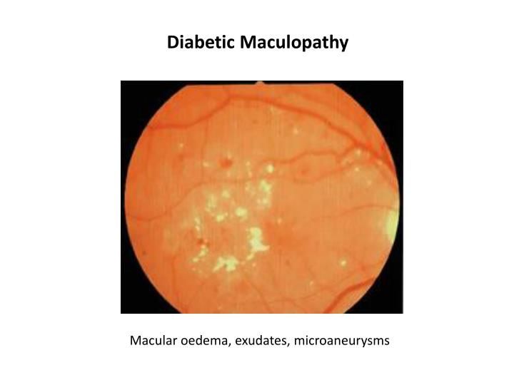 PPT - Ophthalmology for Finals -Revision Lecture PowerPoint ...