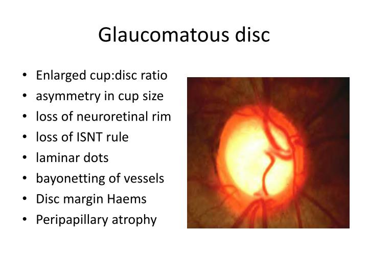 PPT - Ophthalmology for Finals -Revision Lecture PowerPoint ...
