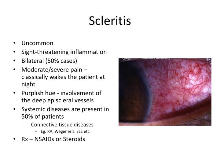 PPT - Ophthalmology for Finals -Revision Lecture PowerPoint ...