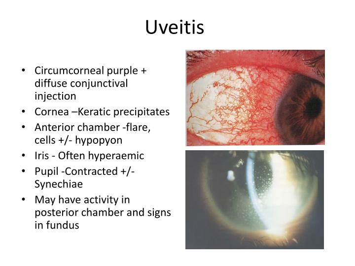 PPT - Ophthalmology for Finals -Revision Lecture PowerPoint ...