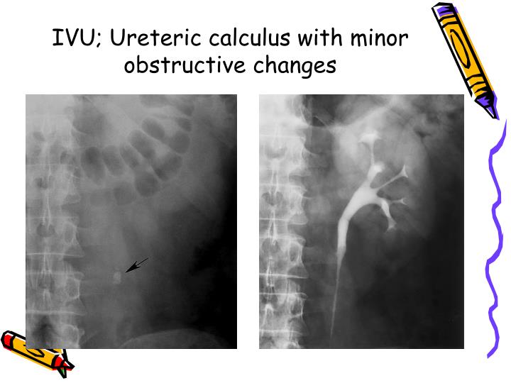 PPT - Acute Conditions in Urology & Scrotal Swellings PowerPoint ...