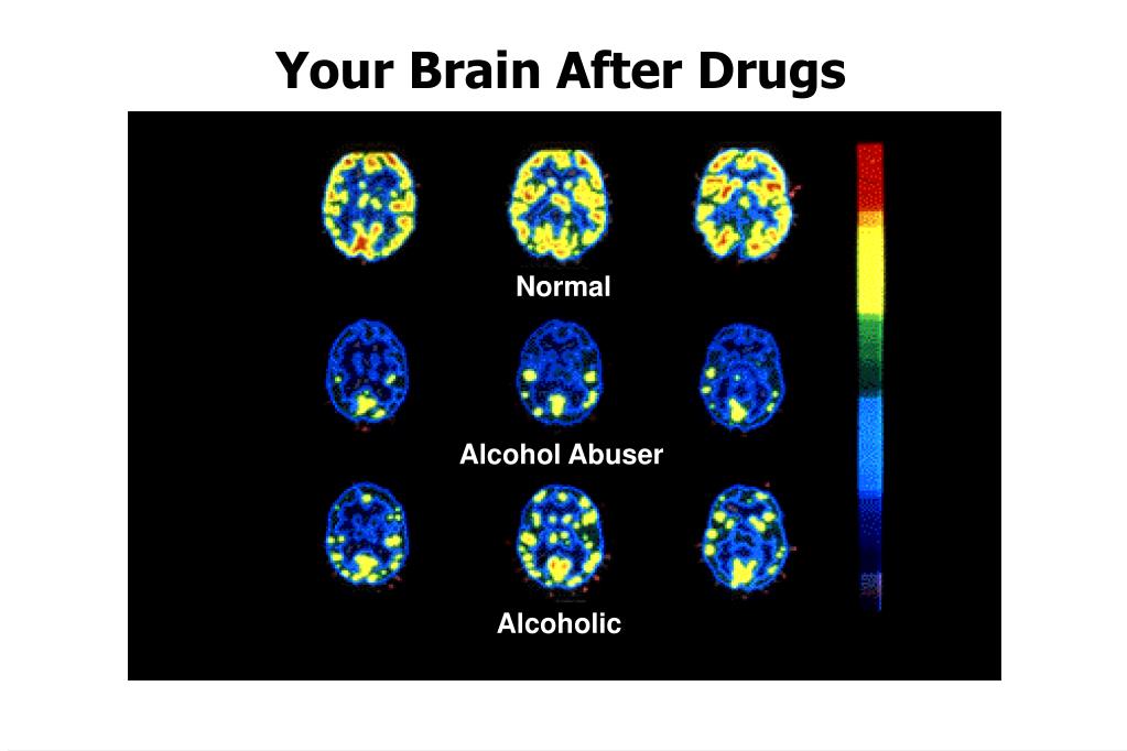 Ppt Alcohol And The Adolescent Brain Powerpoint Presentation Free