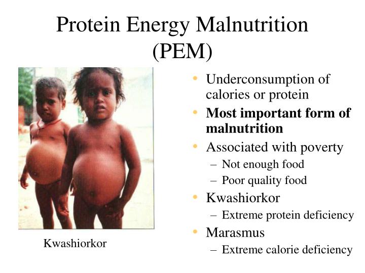 Ppt Malnutrition Defined Powerpoint Presentation Id 318151