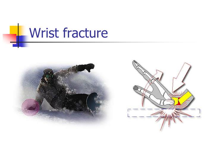 PPT - Ski injuries to the upper extremities PowerPoint Presentation ...