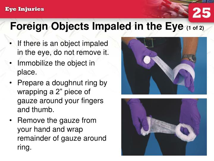 PPT - 25: Eye Injuries PowerPoint Presentation - ID:318474