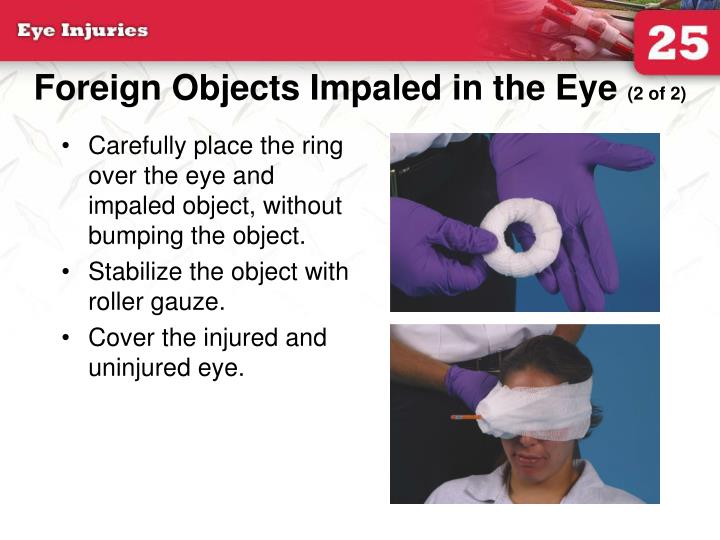 PPT - 25: Eye Injuries PowerPoint Presentation - ID:318474